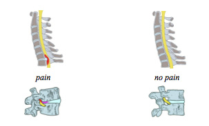 Cox Decompression in Yorba Linda | East Canyon Chiropractic